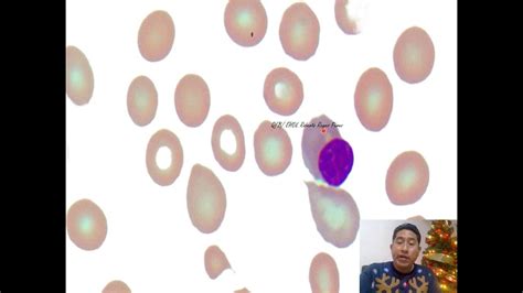 Eritroblasto Ortocromático Expulsando Su Núcleo Youtube