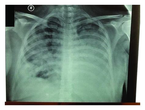 Chest Radiograph Of Day 2 Showing Diffuse Alveolar Opacities Extending Download Scientific