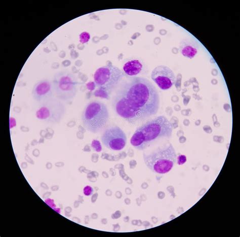 Mesothelial Cells In Body Fluid Stock Image Image Of Diagnosis