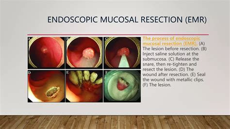 Advances In Third Space Endoscopy Uploadpptx