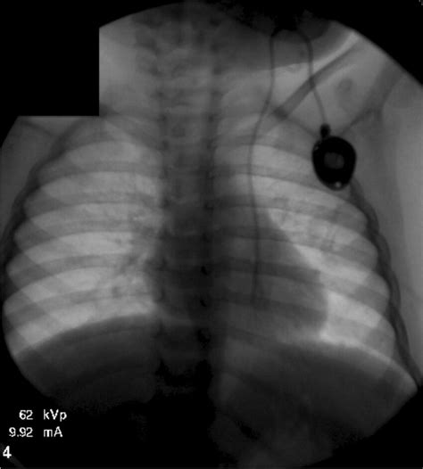 Pre Operative Posteroanterior Fluoroscopic Chest Image—a 5 Year Old Download Scientific Diagram