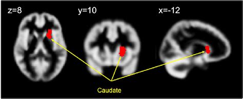 Results Of The Abc Meta Analysis Showing Convergent Clusters In The