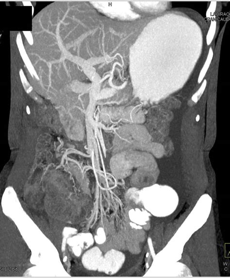 Gastric Cancer With Carcinomatosis Stomach Case Studies Ctisus Ct