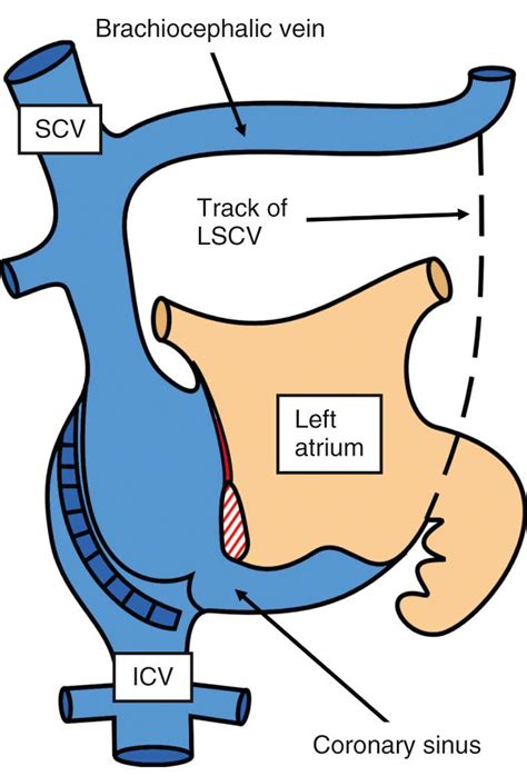 Anomalous Systemic Venous Return Clinical Tree