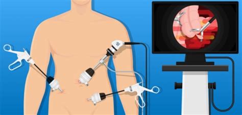 Laparoscopic Colon Surgery In Pune And Mumabi Minimally Invasive Treatment Loc