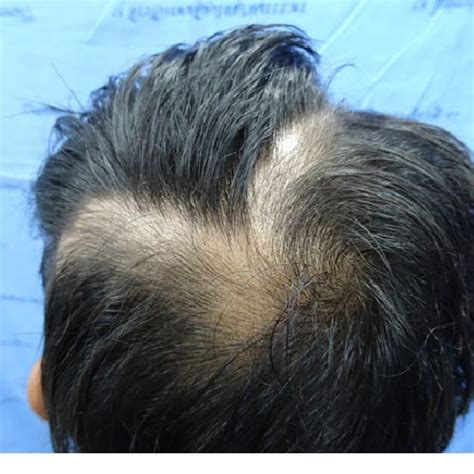 A Case With Lupus Panniculitis Of The Scalp Presenting With Linear Download Scientific Diagram