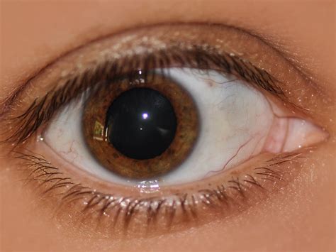 Mydriasis Dilated Pupils Causes And Treatment 42 Off