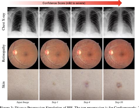 Pie Simulating Disease Progression Via Progressive Image Editing Paper And Code Catalyzex