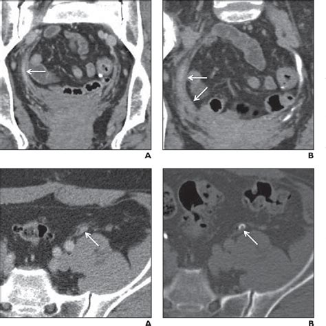 Figure 3—69 From Ct Urography For Diagnosis Of Upper Urinary Tract Urothelial Carcinoma Are