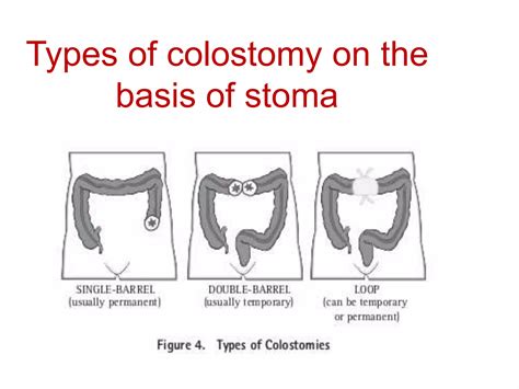 Ppt Of Colostomy Pptx