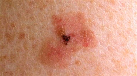 What Does Melanoma Look Like Photos Melanoma Symptoms Treatment And