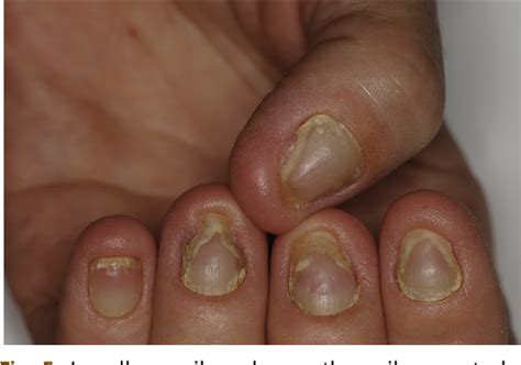 Figure 3 From Tips To Diagnose Uncommon Nail Disorders Semantic Scholar