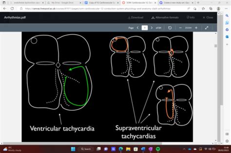 18 CVS Arrhythmias Flashcards Quizlet
