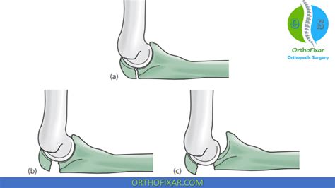 Mayo Classification System Of Olecranon Fractures Mayo Classification
