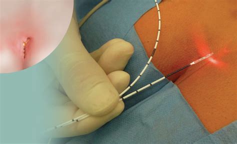 Pilonidal Sinus Starsuratpiles