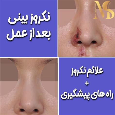 علت نکروز بینی بعد از جراحی علائم اولیه و درمان نکروز بینی دکتر صابری