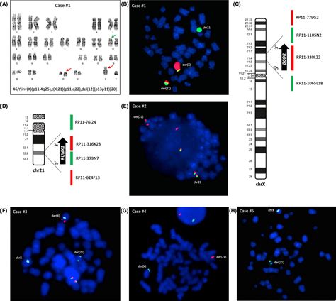 A Novel T X 21 P11 4 Q22 12 Translocation Adds To The Role Of Bcor