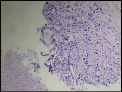 Adenocarcinoma Of The Lung With Acinar Growth Fnab Hande 100×