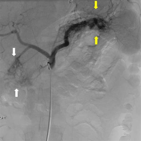 The Superior Mesenteric Angiogram Demonstrating Significant Vascular
