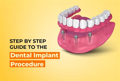 Dental Implants Procedure