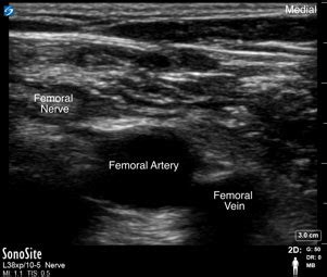 Fascia Iliaca Block RCEMLearning India