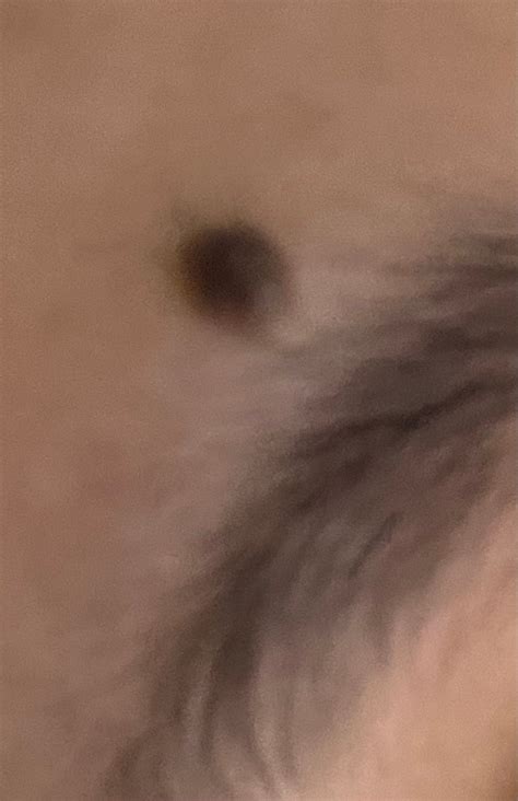 점빼기 궁금한점 지식in