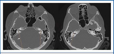 Figure 2 From Position Of Retrosigmoid Craniotomy In Hearing Preservation Surgery For Vestibular