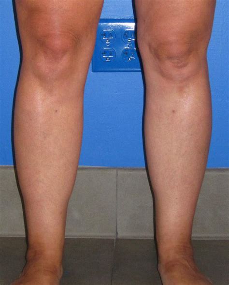 Calf And Ankle Liposuction Phoenix Liposuction