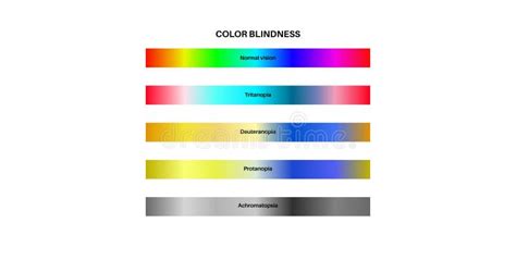 Protanomaly And Protanopia Stock Vector Illustration Of Dichromacy