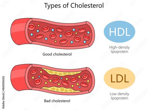HDL Good Cholesterol And LDL Bad Cholesterol In Blood Vessels For Health Education Diagram Hand