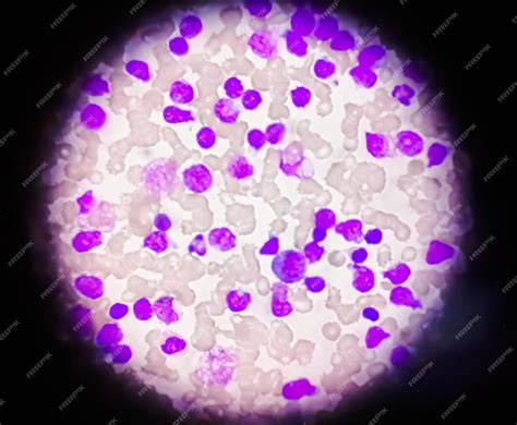 Premium Photo Blood Smear Under Microscopy Showing Chronic