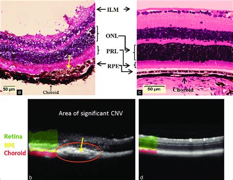 The Subretinal Injection Induced Choroidal Neovascularization A And B Download Scientific