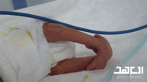 جنایات پنهان سعودیها؛ ناهنجاری های مادرزادی کودکان یمنی ایرنا