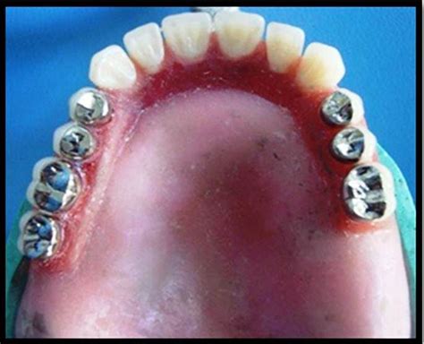 Prosthesis On Prosthesis Three Fourth Metal Crowns—a Novel Approach