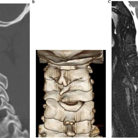 A Computed Tomography Ct Images Showing Left Facet Dislocation At