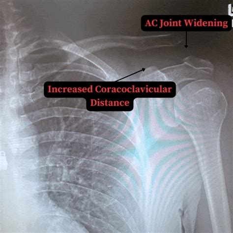 Acromioclavicular Joint Separation