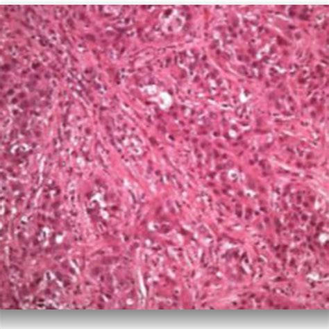 Microscopic Appearance Of Cholangiocellular Carcinoma Heand200 Download Scientific Diagram