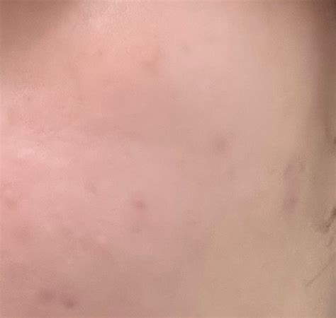 피부 착색 지식in