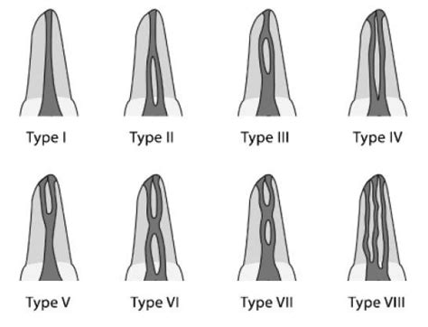 Diagrammatic Representation Of Vertuccis Root Canalconfigurations 4