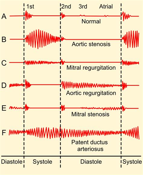 Heart Murmurs Heart Sounds Geeky Medics