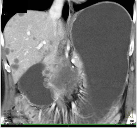 Pancreatic Cancer Invading The Duodenum In A Patient With Extensive