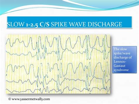 Issues In Brainmapping The Secrets Of Conventional Eeg Pptx Brain And Nervous System