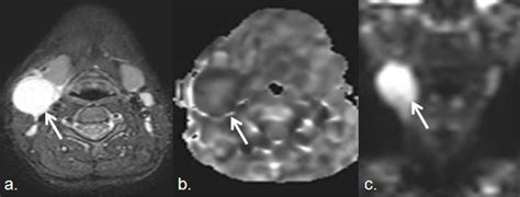 Shotty Retroperitoneal Lymph Nodes Tyredmorning