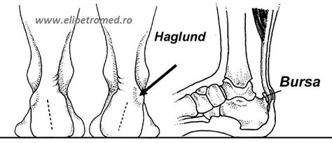 Fiziokinetoterapia în Maladia Haglund Fiziokinetoterapie şi Recuperare