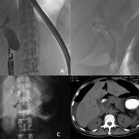 Distal Migration Of Partially Covered Self Expanding Metallic Stents
