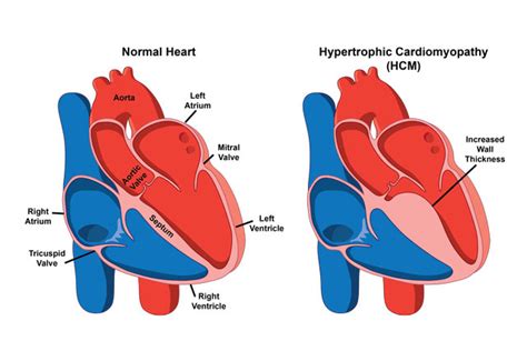 Hypertrophic Cardiomyopathy The Johns Hopkins Heart And Vascular
