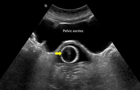 Pocus Gallery Renal Fellow Network