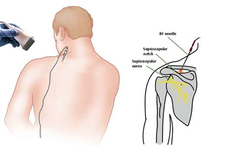 Supraclavicular Nerve