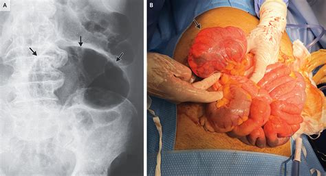 Cecal Volvulus Vs Sigmoid Volvulus