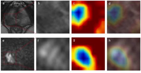 Mri Based Ai Radiomics Model Offers Robust Prediction Of Perineural Invasion In Prostate Cancer